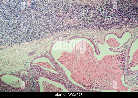 Cyst adenolymphoma diseased tissue under the microscope 100x Stock ...
