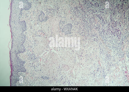 Lips carcinoma under the microscope 100x Stock Photo - Alamy