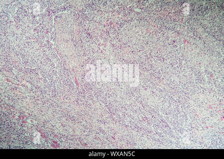 Lips carcinoma under the microscope 100x Stock Photo - Alamy