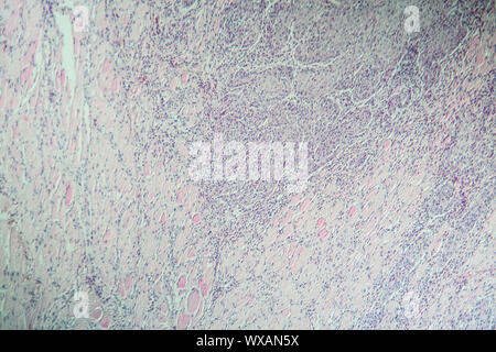 Lips carcinoma under the microscope 100x Stock Photo - Alamy