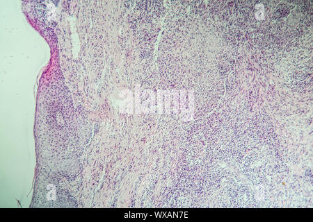 Lips carcinoma under the microscope 100x Stock Photo - Alamy