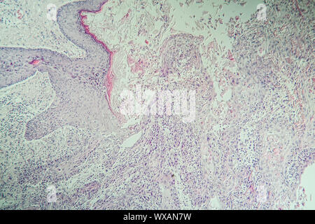 Lips carcinoma under the microscope 100x Stock Photo - Alamy