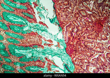 Colon cancer tissue section under the microscope 100x Stock Photo - Alamy