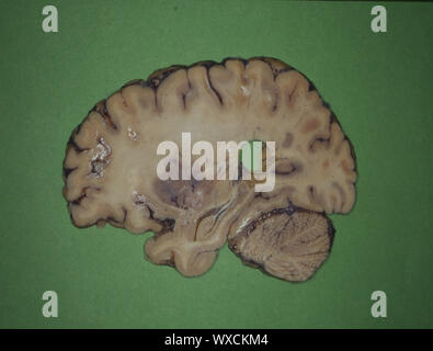 Human brain in longitudinal and cross section Stock Photo - Alamy