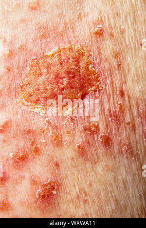 Basal cell carcinoma skin cancer. Close-up of a nodular basal cell ...