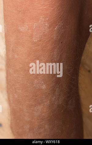 Large plaque parapsoriasis on caucasian man legs Stock Photo - Alamy