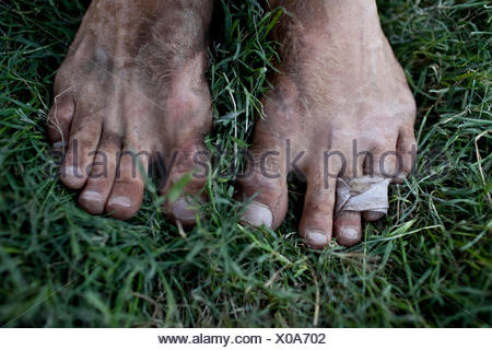Dirty feet with bandaged broken toes Stock Photo - Alamy