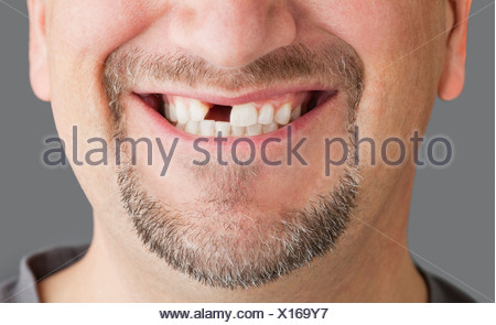 Man with missing front tooth Stock Photo - Alamy