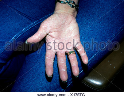 Fungus infection called Tinea manus on the hand. Also known as Stock ...