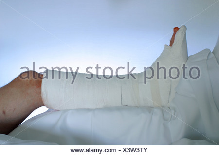 Gipsbein in Krankenhausbett Stock Photo - Alamy