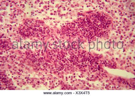 Lymph node under the microscope Stock Photo: 93555454 - Alamy