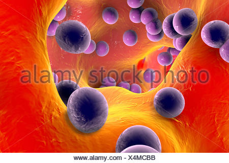 Staphylococcus aureus bacteria infected bone (osteomyelitis Stock Photo ...