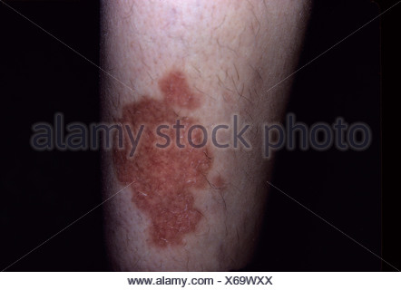 Necrobiosis lipoidica diabeticorum is a rash which usually occurs on ...