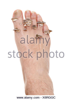 Foot Fungus disease with a close up of the human body showing toes ...