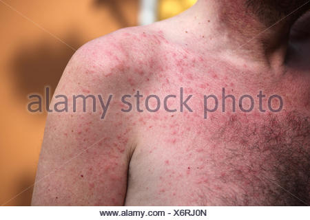 Skin rash or sun allergy Stock Photo: 70053048 - Alamy