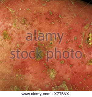 Potato cyst nematode (Heterodera spp.) feeding damage to potato tuber ...