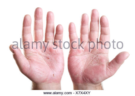 Skin rash of eczema on the palms of a 55 year old man showing severe ...
