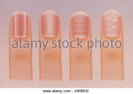 PATHOLOGY OF THE NAIL, DRAWING Stock Photo: 49172194 - Alamy
