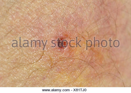Entzuendeter Zeckenbiss infected tick bite on thigh Stock Photo - Alamy