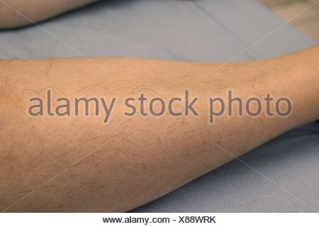 woman with hirsutism Stock Photo - Alamy