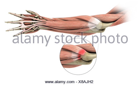 Illustration of a tennis elbow (lateral epicondylitis Stock Photo ...