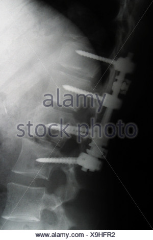 medicine back surgery Titanium Rods Titanium screws Titanium 360 Stock ...