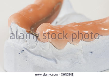 dental impression, adjusted bite splint, Michigan splint, medium Stock ...