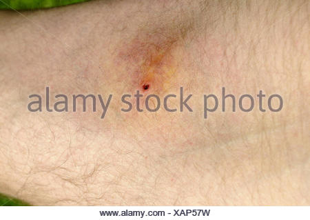 Entzuendeter Zeckenbiss infected tick bite on thigh Stock Photo - Alamy