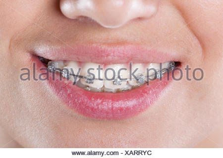 Mouth open with beautiful teeth braces and tongue out isolated on Stock ...