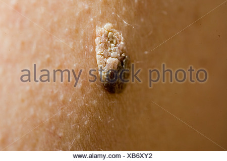 Common wart, verruca senilis Stock Photo - Alamy