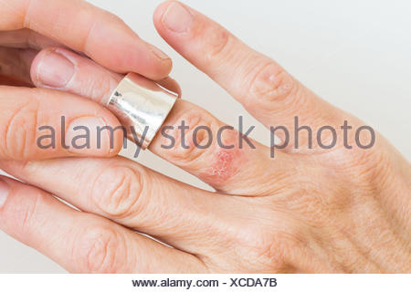 Contact dermatitis on finger Stock Photo: 73819069 - Alamy