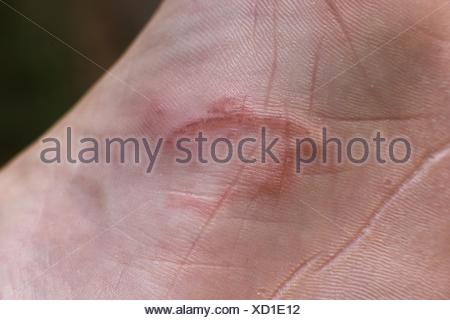 Cutaneous larva migrans rash on sole of foot caused by burrowing Stock ...