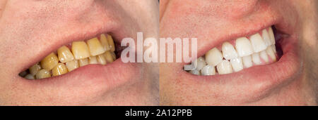 Rauchen, Plaque auf den Zähnen menschlichen Zähnen nach dem Rauchen ...