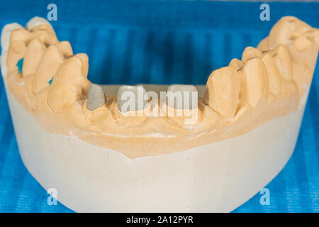 Zahnmedizinische casting Modell Gips Gips Stockfoto, Bild: 169170153 ...