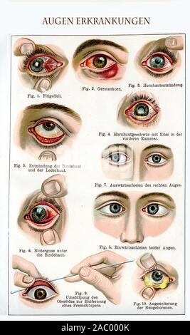 Illustration der allergischen Konjunktivitis. Bindehautentzündung ist ...