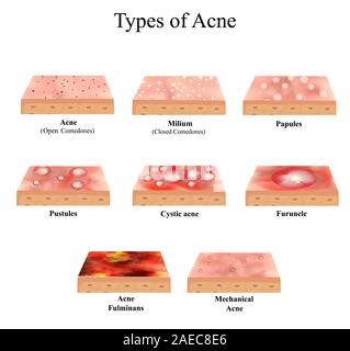 Papeln auf der Haut. Akne. Pickel auf der Haut Hintergrund. Akne auf ...