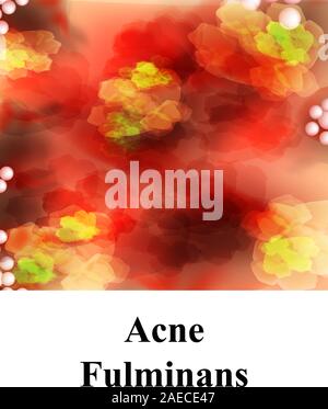 Pusteln auf der Haut. Zystische Akne. Pickel auf der Haut Hintergrund ...