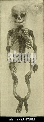 Rachitis Femur Tibia Stockfotografie - Alamy