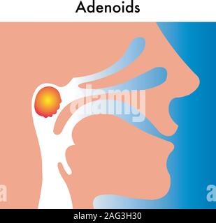 Medizinische Darstellung der Symptome der Mandelentzündung Stock ...