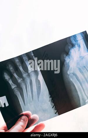 Röntgenbild der Fraktur Bein (Tibia) mit Implantat-Platte und Schraube ...