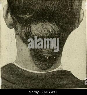 . Textbuch der operativen Chirurgie . Abb. 145. – Exzision des ...