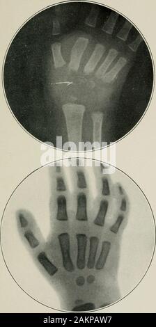 Röntgenaufnahme des Karpaltunnelsyndroms und Mittelhandknochen Knochen ...