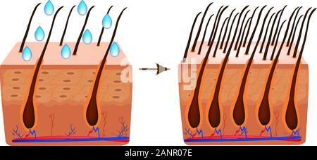 Seborrhea Haut und Haare. Schuppenborrhein-Dermatitis. Dysfunktion der ...