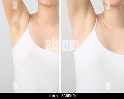 Weibliche achseln vor und nach der Rasur. Frau mit behaarten Achseln ...