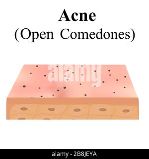 Öffnen Sie die Komedonen. Akne auf der Haut. Dermatologische und ...