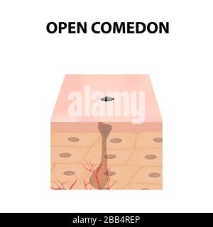 Öffnen Sie die Komedonen. Akne auf der Haut. Dermatologische und ...