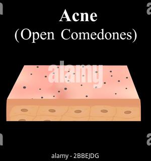 Öffnen Sie die Komedonen. Akne auf der Haut. Dermatologische und ...
