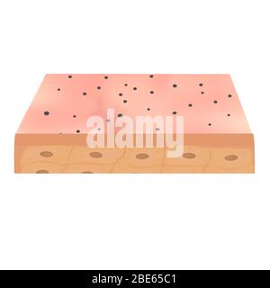 Öffnen Sie die Komedonen. Akne auf der Haut. Dermatologische und ...