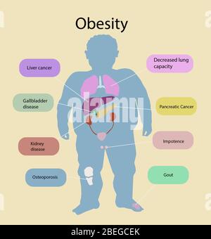 Diagramm der Adipositas Stockfotografie - Alamy