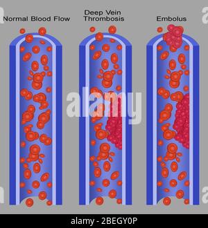 Eine tiefe Venenthrombose (DVT) ist ein Blutgerinnsel (Thrombus), das ...